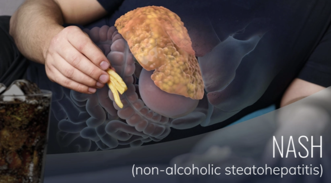 肝病: FGF19靶点 - 非酒精性脂肪肝炎NASH临床2b-上海优宁维生物科技股份有限公司